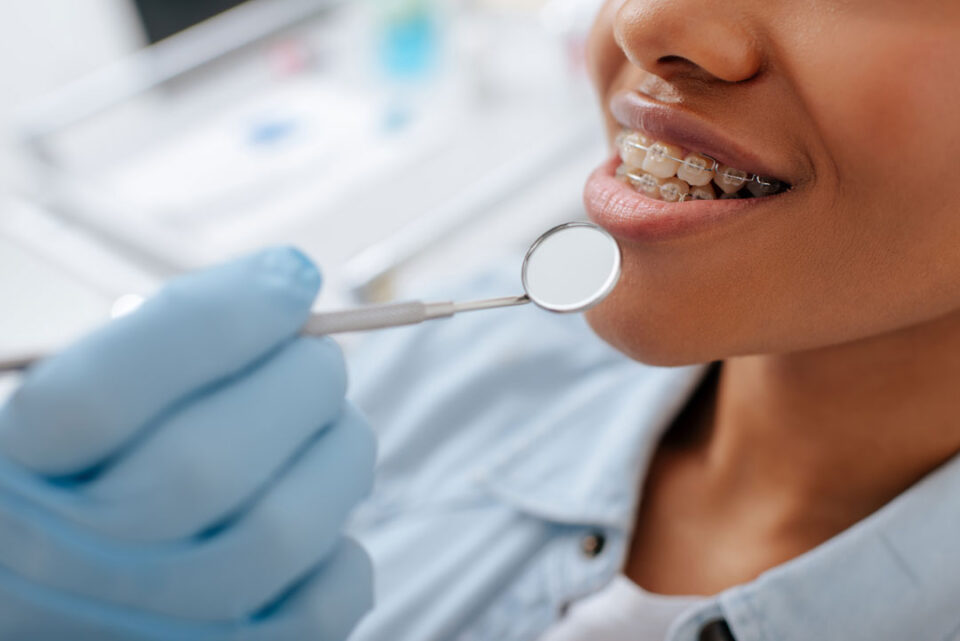 Dental Embrasure: Definition and Classification
