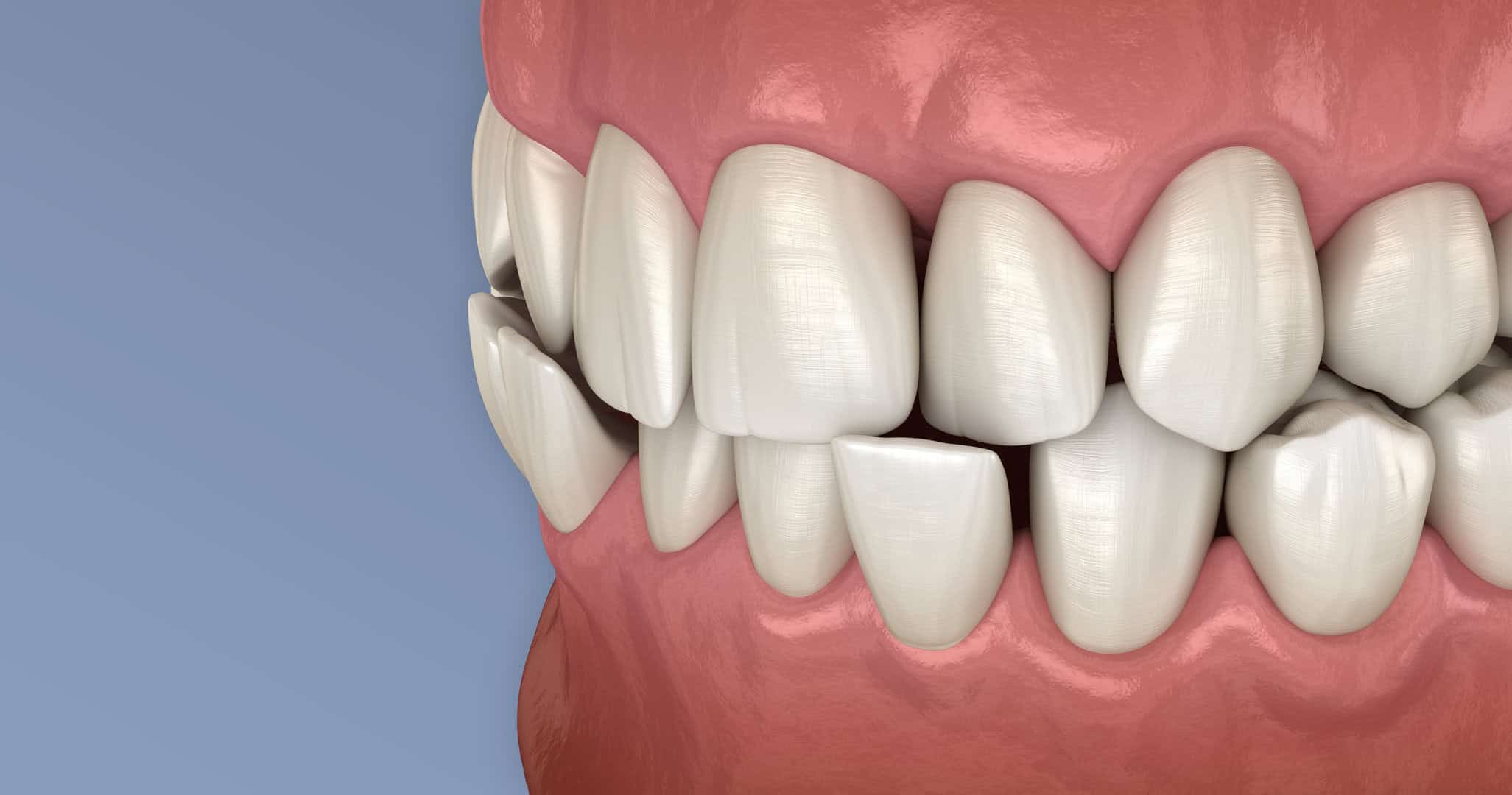 Crossbite in - Leaver and Gardner Orthodontics
